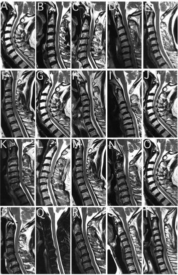 Bilateral Finger Jerks as a Useful Sign for Diagnosis of Cervical ...